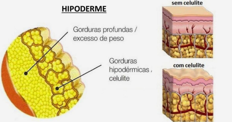 Hipoderme - O que é, função, composição, camadas da pele, celulite